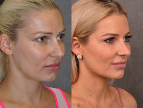 Profound RF/Skin Tightening – Before & Afters - Beverly Hills Center