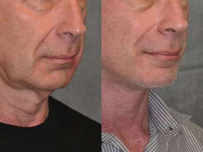 Male Plastic Surgery - Before & Afters - Beverly Hills Center