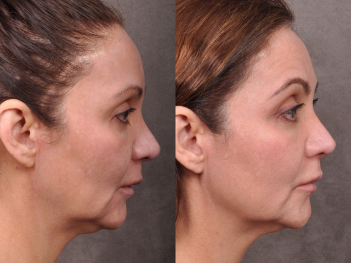 Laser Facelift / Profound MicroLift – Before & Afters - Beverly Hills ...