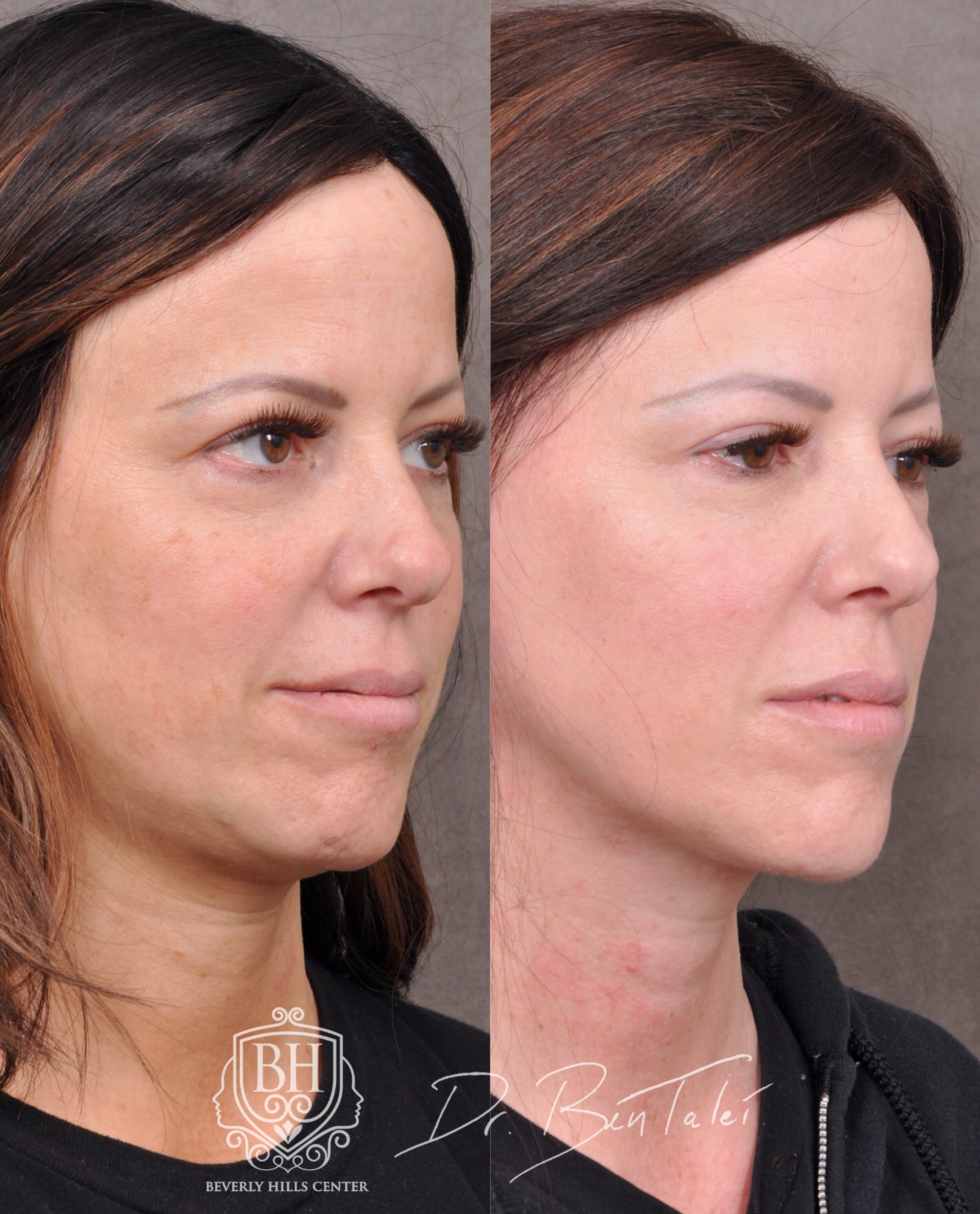Profound RF/Skin Tightening – Before & Afters - Beverly Hills Center