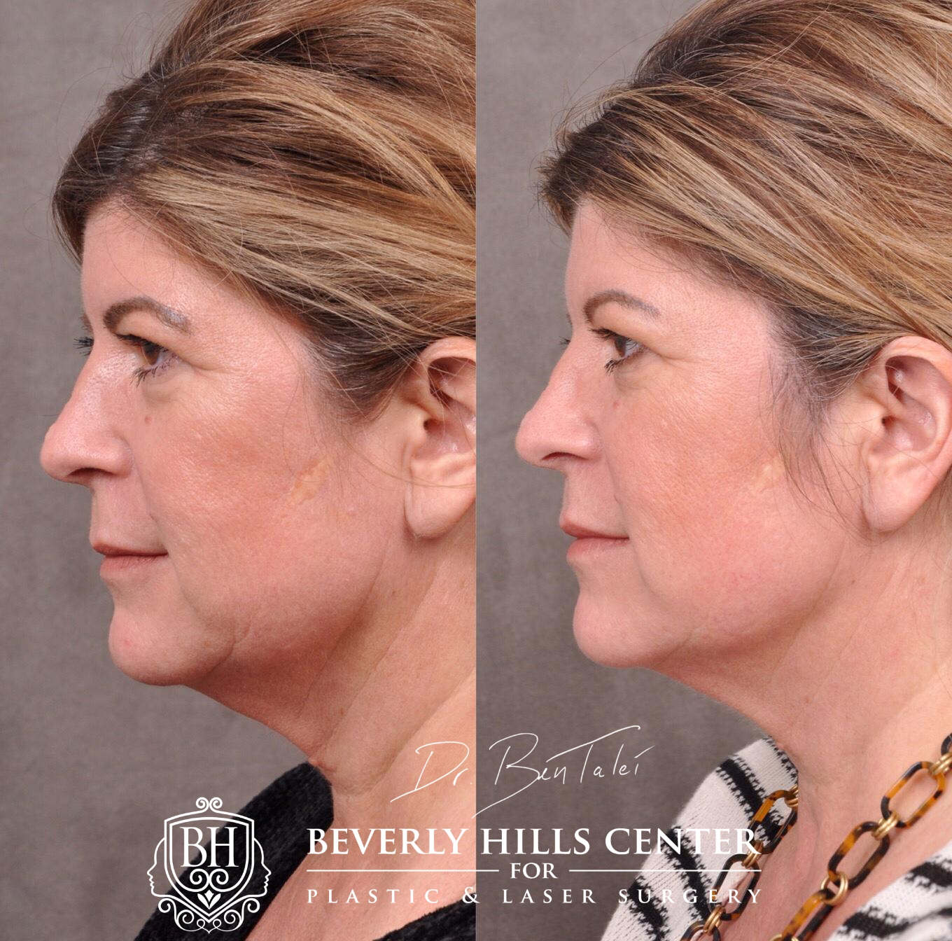 Profound RF/Skin Tightening – Before & Afters - Beverly Hills Center