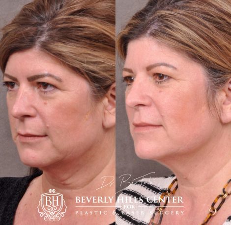 Profound RF/Skin Tightening – Before & Afters - Beverly Hills Center