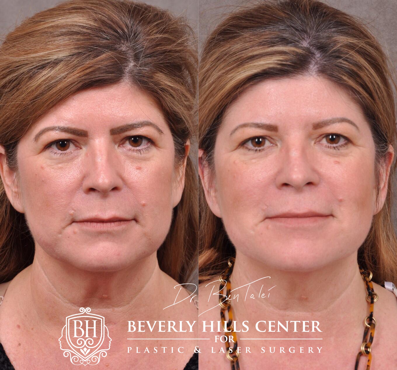 Profound RF/Skin Tightening – Before & Afters - Beverly Hills Center