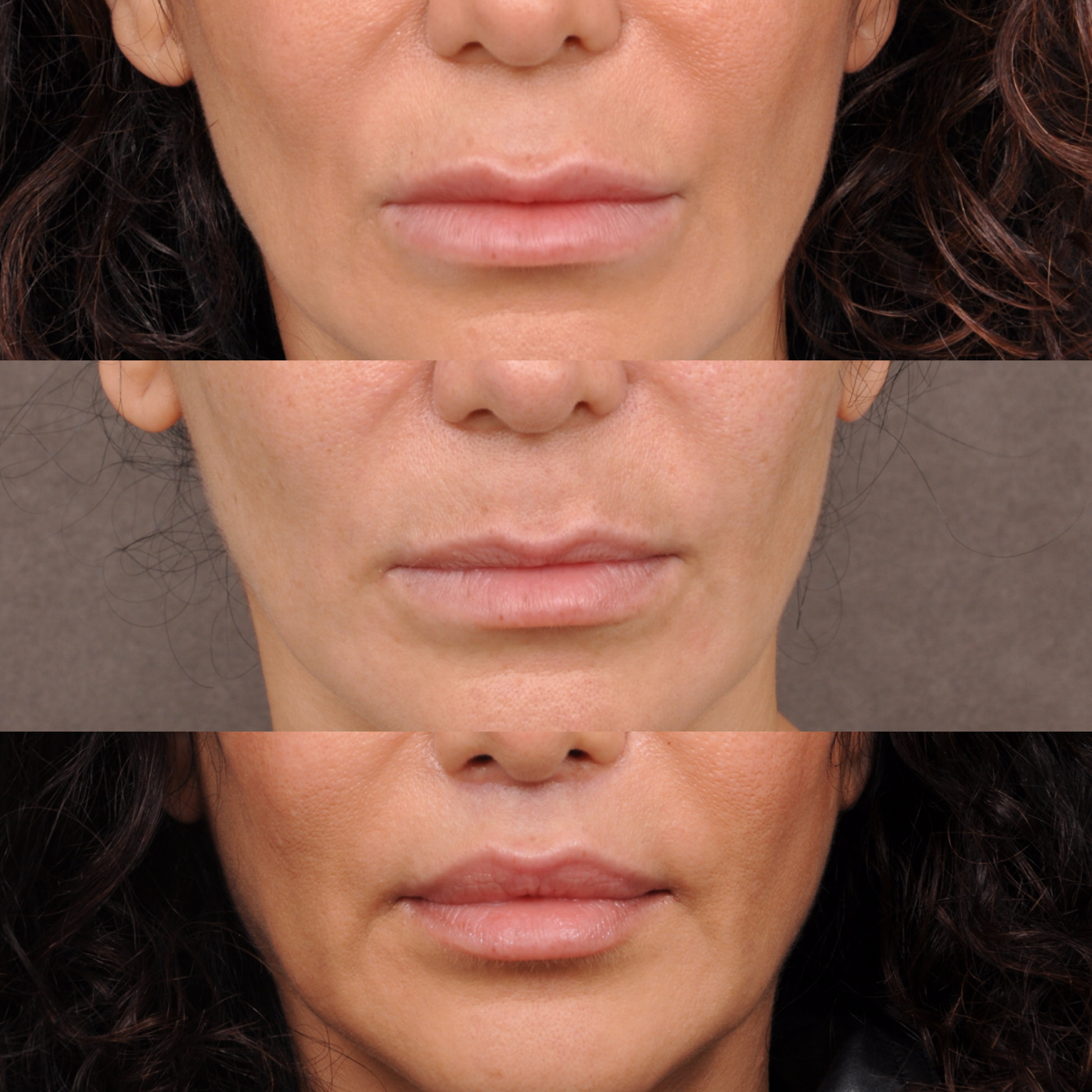 Lips – Before & Afters - Beverly Hills Center