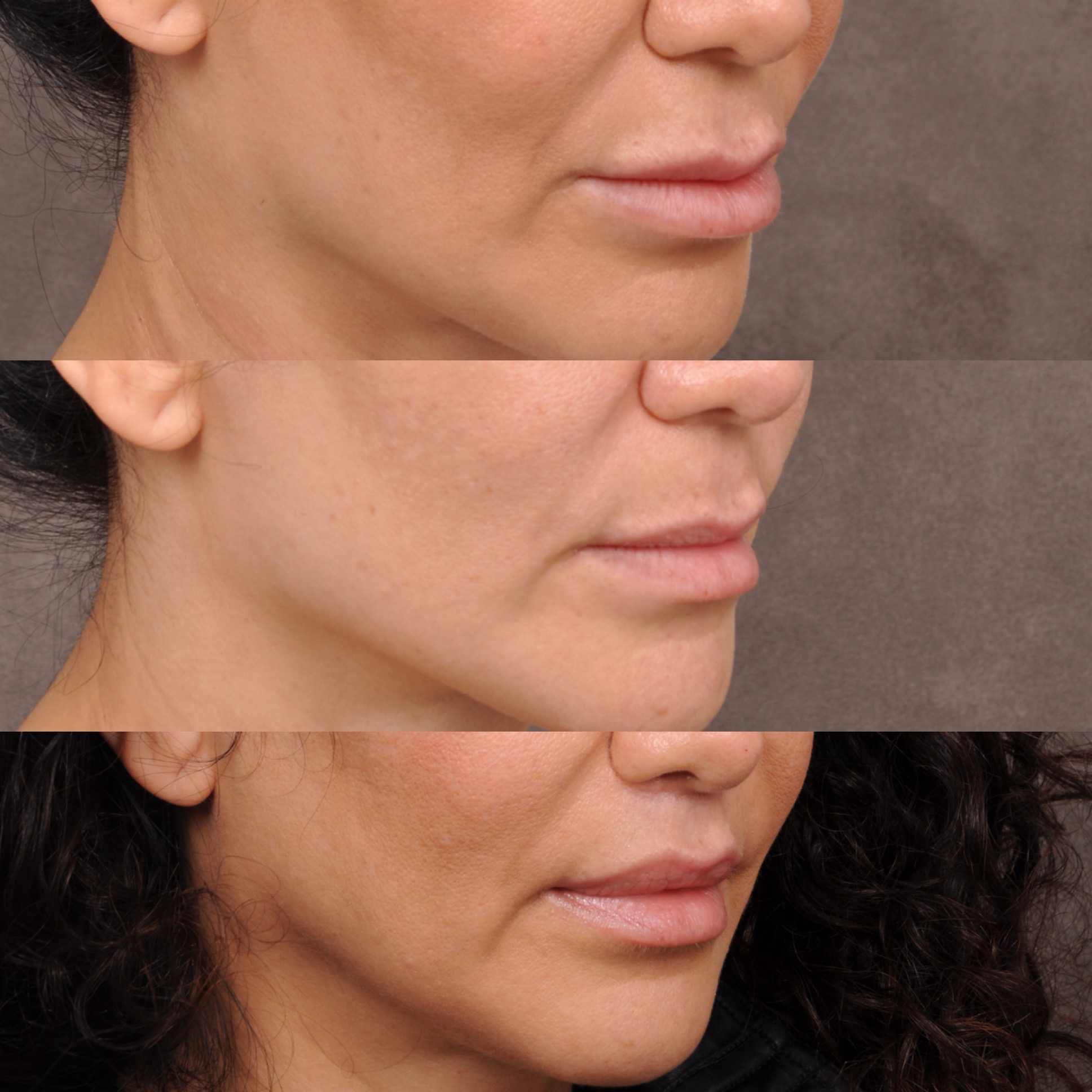 Lips – Before & Afters - Beverly Hills Center