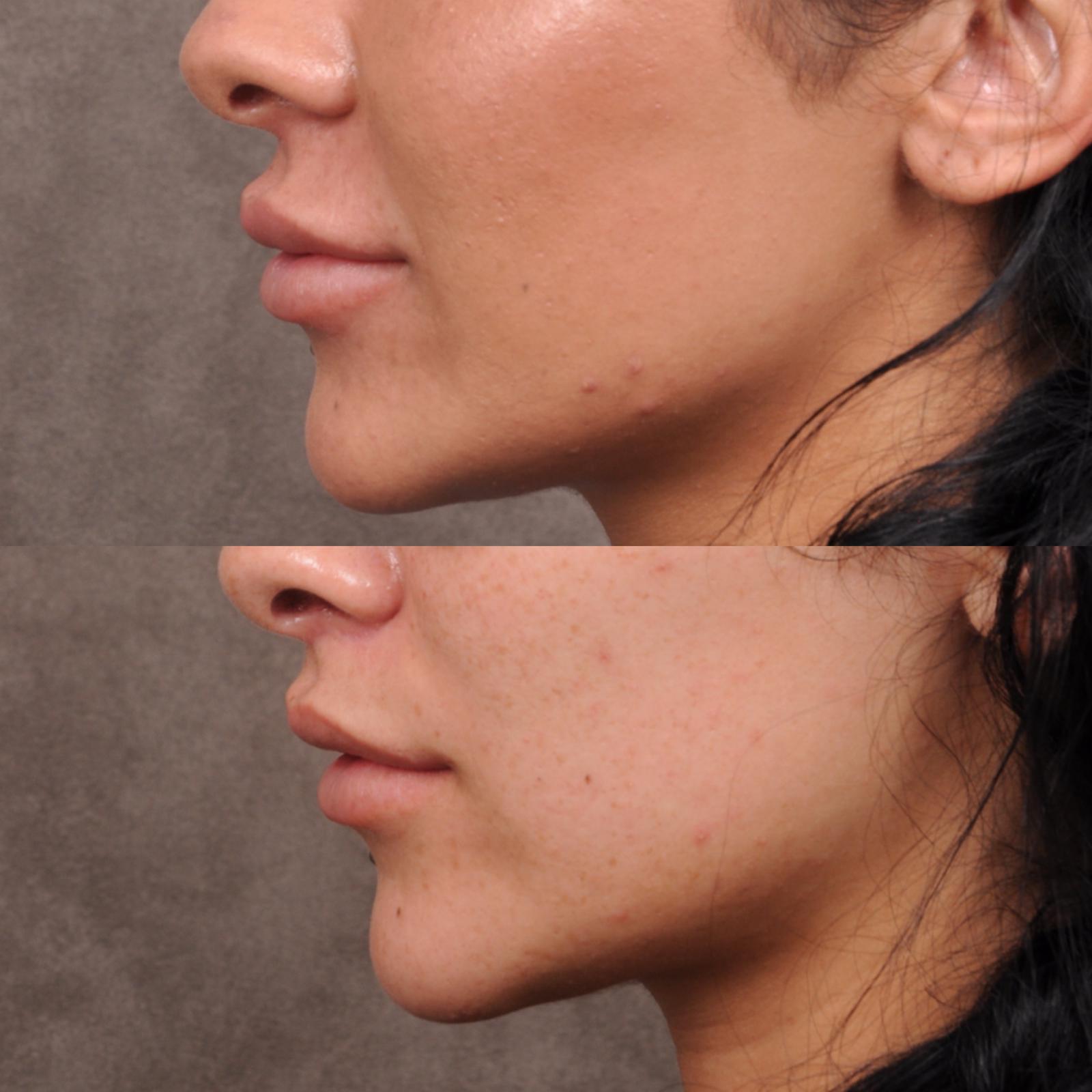 Lips – Before & Afters - Beverly Hills Center