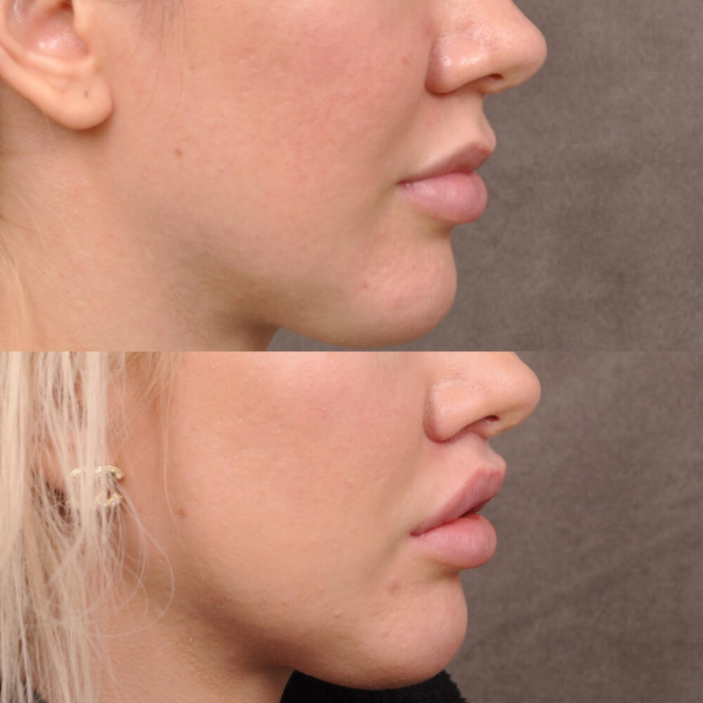 Lips – Before & Afters - Beverly Hills Center