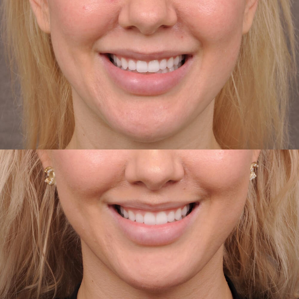 Lips – Before & Afters - Beverly Hills Center